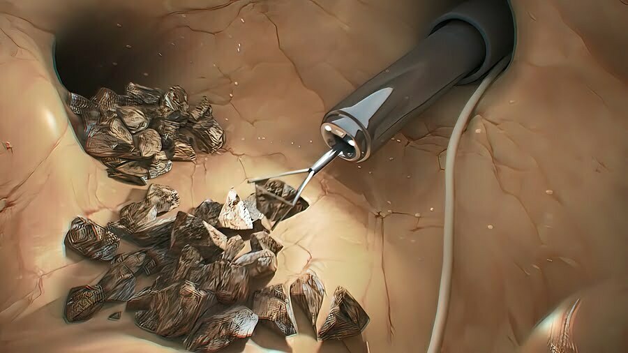 ai-robots-created-to-remove-kidney-stones